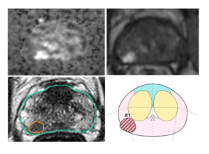 mpMRT Prostata: Kostenübernahme | RIZ Augsburg